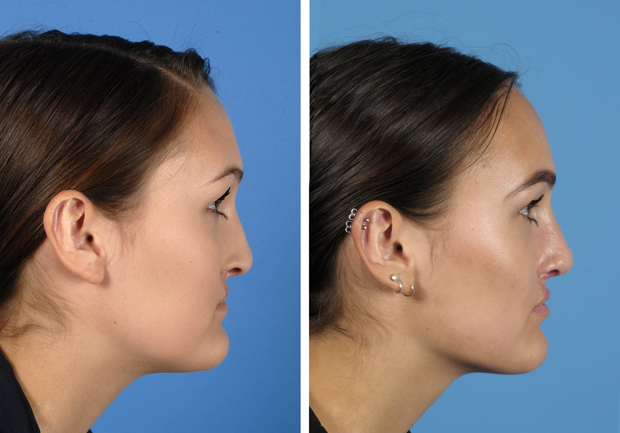 secondary cleft lip nose #1 - Rhinoplasty.care