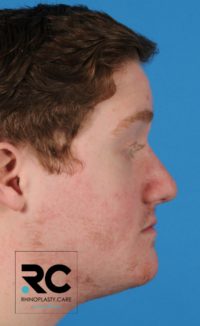 Pseudohump / low radix - Rhinoplasty.care