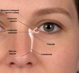 Traanwegchirurgie (DCR) - Rhinoplasty.care