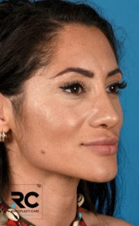 Inverted-V deformity - Rhinoplasty.care