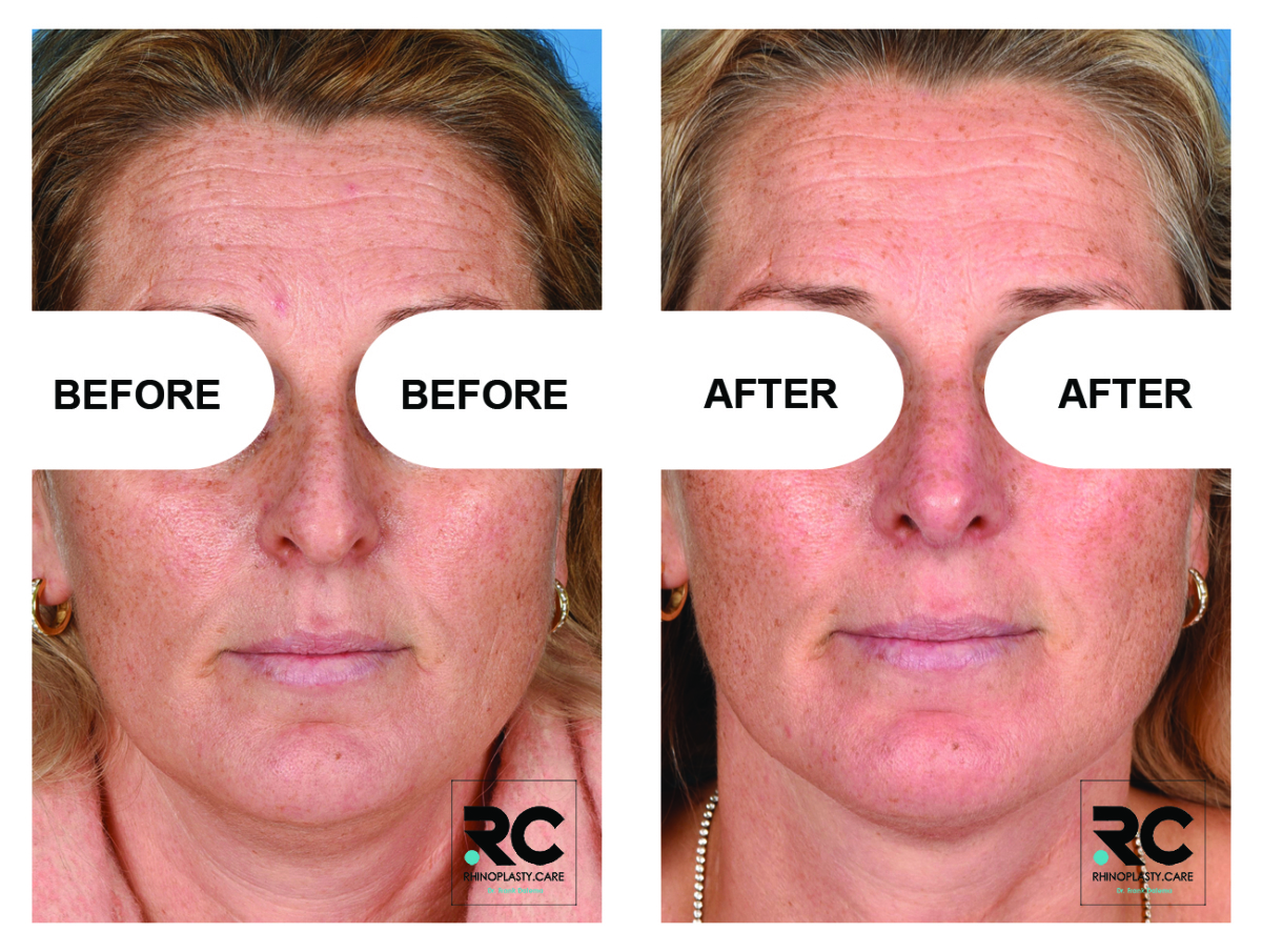 Voor-na foto's - Rhinoplasty.care